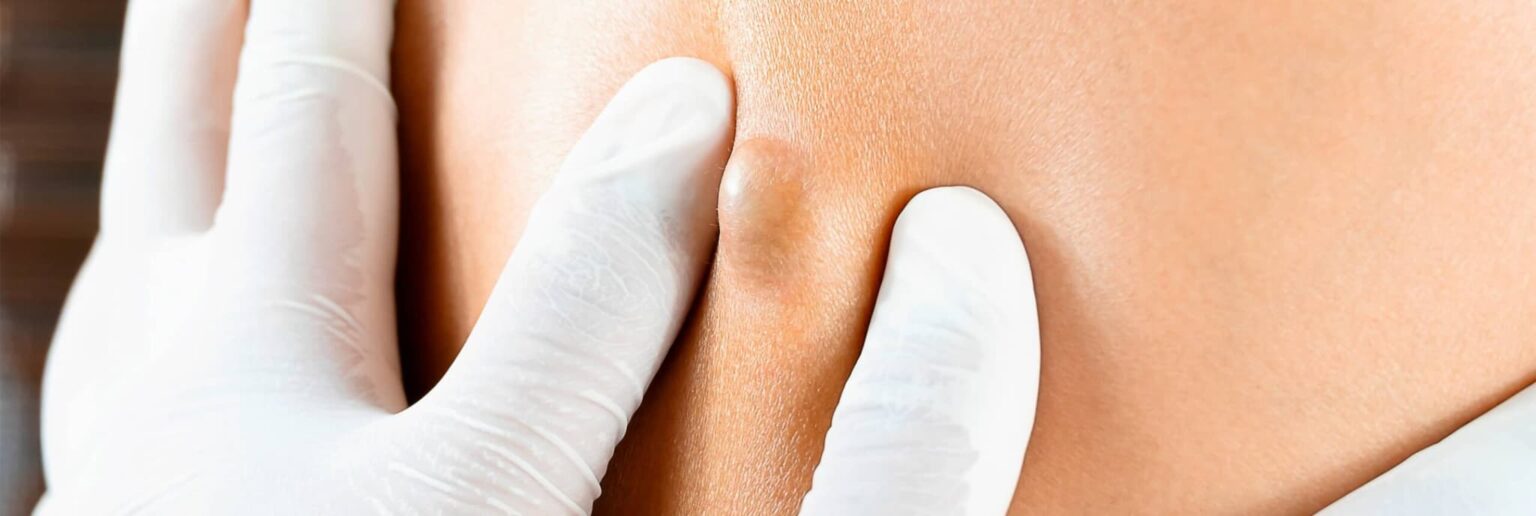 Lipome ou Kyste : Quelle est la différence ? - Docteur Gianfermi