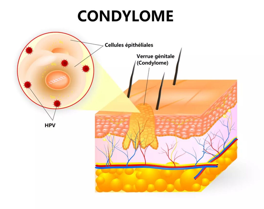Condylome : définition, transmission et symptômes - Docteur Gianfermi