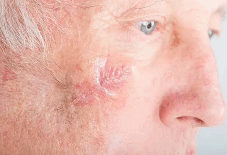 Lipome ou Kyste : Quelle est la différence ? - Docteur Gianfermi